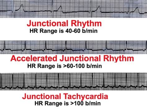 Difference In Idioventricular And Junctional Rhythm