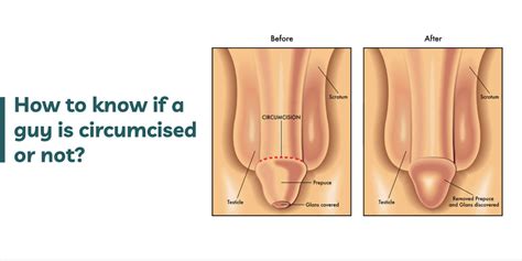 Circumcised