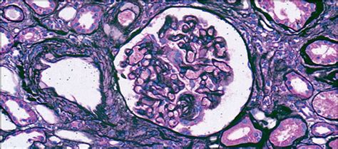 C3 Glomerulopathie Bij Een Mgrs Op Basis Van Een Monoklonaal Iga Kappa Waarvoor Succesvolle