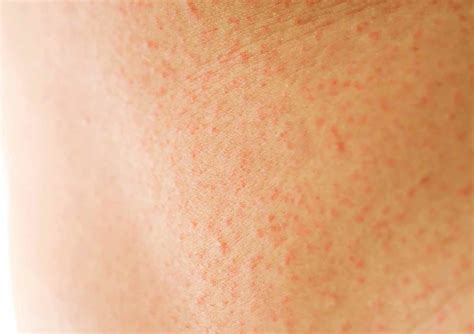 Leg Chafing Rash At Cameron Maughan Blog