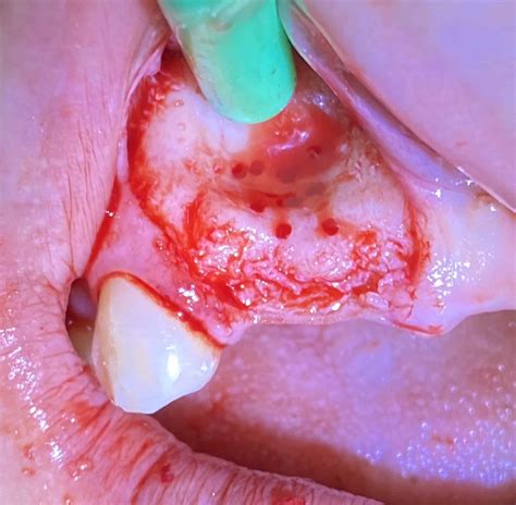 Bone Block Graft Harvested From Lower Jaw To Upper Left Quadrant Case