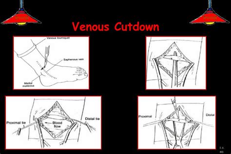 Ppt Vascular Access Powerpoint Presentation Free Download Id 6691830