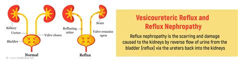 Nephropathy What Is Reflux Nephropathy