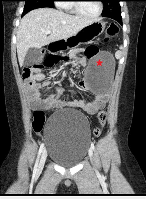 Figure 2 From A Case Report Of Axial Torsion Of Meckels Diverticulum An Acute Abdomen Without