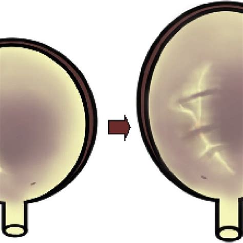 Incision Of Bladder Scar With Holmium Laser Note The Exposure Of