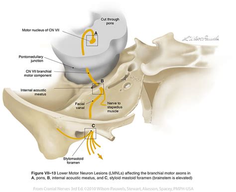 Intracranial Cavity Extra Axial Posterior Cranial Fossa Internal