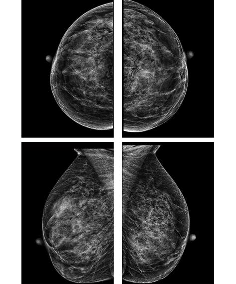 Breast Cyst Mammogram