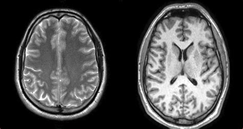 Figura 2 Caso 2resonancia Magnética De Cerebro Sin Anomalías