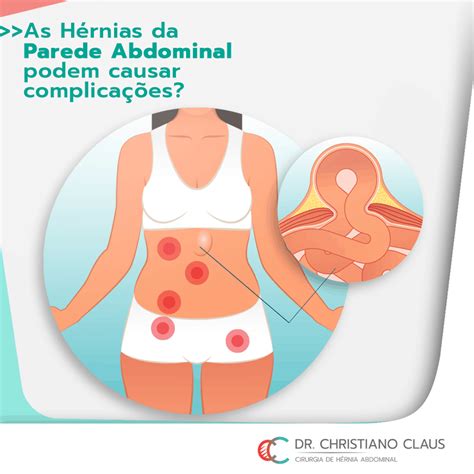 As Hérnias Da Parede Abdominal Podem Causar Complicações Dr