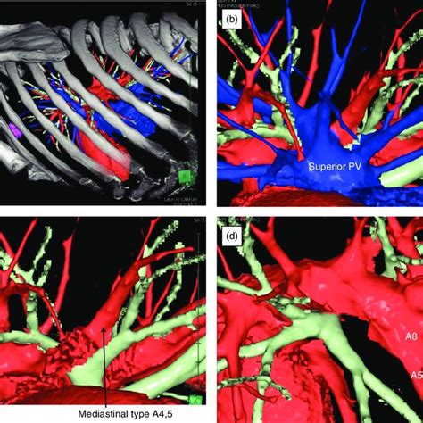 Preoperative Simulation Of Left Upper Lobectomy A Confirmation Of
