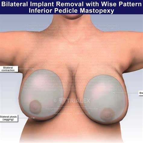 Medical Legal Exhibits Legal Animations And Trial Graphics Tria