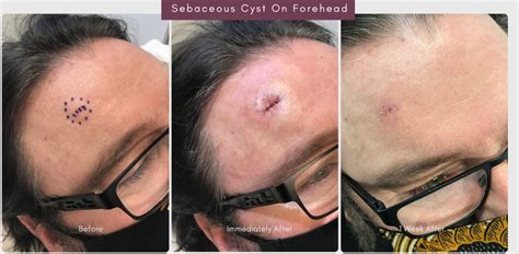 Acne Cyst Surgical Removal