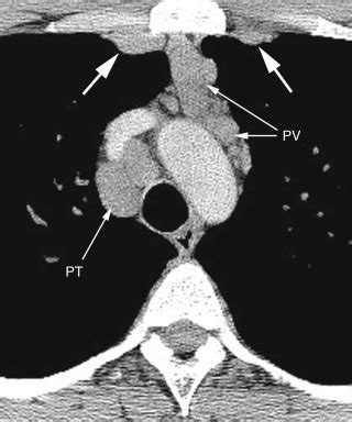 Mediastinum Lymph Node Abnormalities And Masses Radiology Key