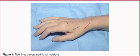 Figure 1 From A Simple And Quick Tendon Transfer Technique To Restore