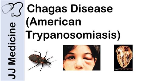 Symptoms Of Chagas Disease Chagas Disease Causes Symptoms