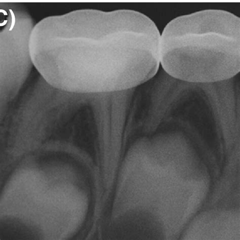 Pdf Management Of Primary Molars With Irreversible Pulpitis Employing