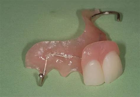 Dental Flipper Choices What Are Your Options Whats Cost