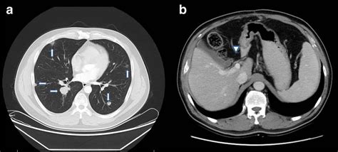 Postoperative Ct Image Of The Same Patient During The Follow Up A