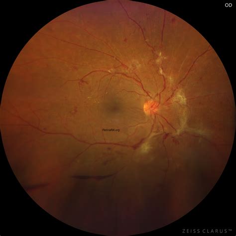 Proliferative Diabetic Retinopathy Retinara