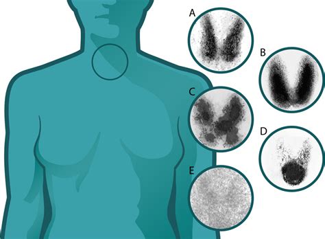 Hyperthyroidism Teachmepaediatrics