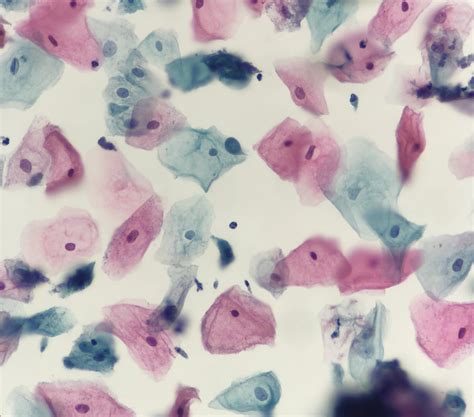Trichomonas