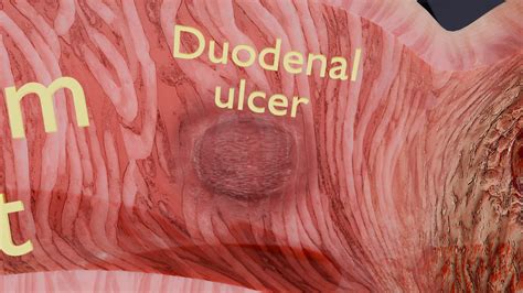 3d Peptic Ulcer Stomach Duodenum Turbosquid 2429849