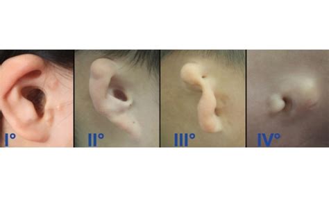 Classification Of Microtia Dari Telinga Kecil Hingga Anotia