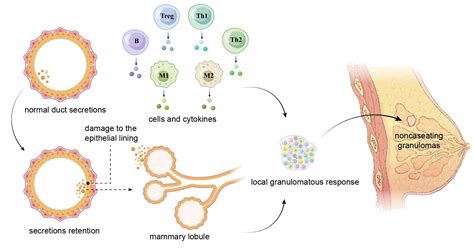 Frontiers Immune Pathogenesis Of Idiopathic Granulomatous Mastitis