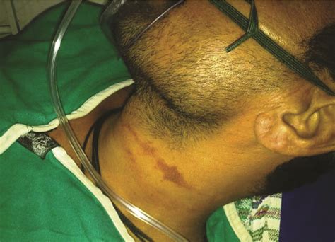 Ligature Marks From Hanging