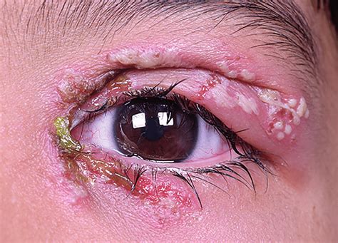 Blepharo Conjunctivitis Figure 2 Dendritic Ulcer Figure 3 Geographical