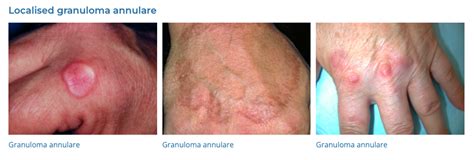 Annular Rash Like Ringworm Gp Exams