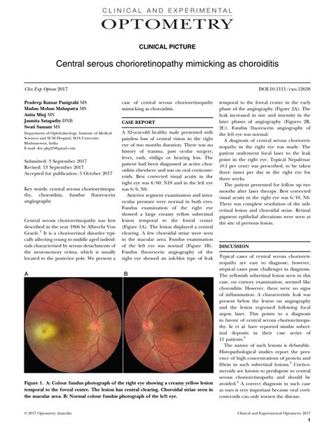 Pdf Central Serous Chorioretinopathy Mimicking As Choroiditis