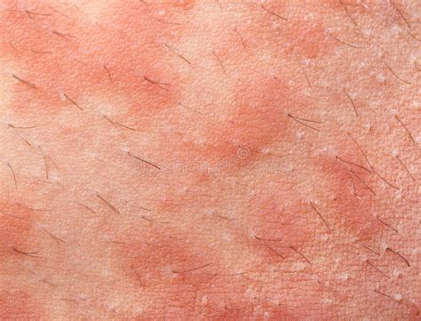 Atopisk Dermatit Och även Känt Som Atopisk Eksem är En Typ Av Hudinflammation Dermatit