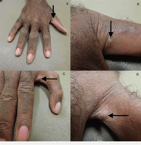 Scabies Linear Burrows