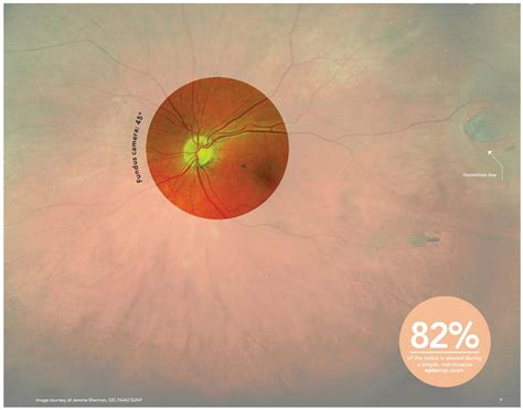 See The Full Picture With Ultra Widefield Retinal Imaging