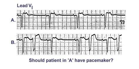 Ecg Learning Center An Introduction To Clinical Electrocardiography