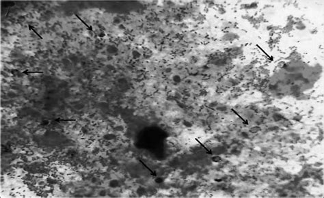 Modified Acid Faststained Slide From Suspected Sample Showing