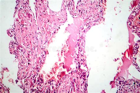 Red Hepatization Stage Of Lobar Pneumonia Photomicrograph Showing Alveolar Exudate With Red
