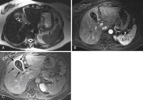 Mri Of The Gallbladder And Biliary System Clinical Tree