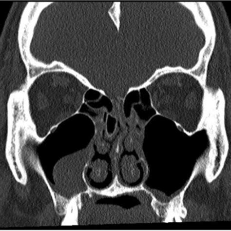 Coronal Computed Tomography Ct Showing Right Maxillary Polyp