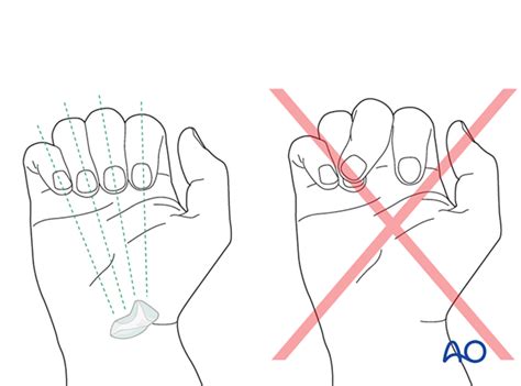 Nonoperative Treatment For Dislocation And Fracture Dislocation Of The