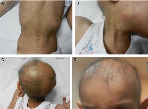 Reticulated Hyperpigmentation On The A Abdomen And B Neck C D