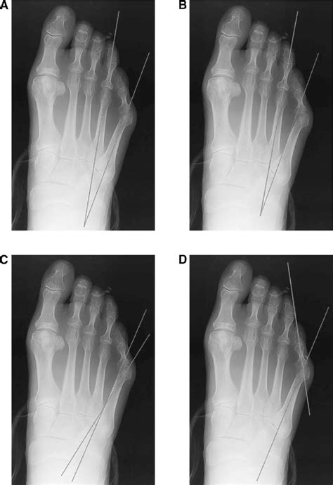 A Fourth To Fifth Intermetatarsal Angle Axes Bisect The Fourth And