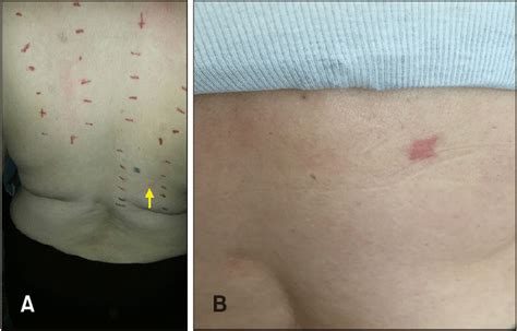 A Positive Patch Test Reaction To Bacitracin At 48 Hours Yellow