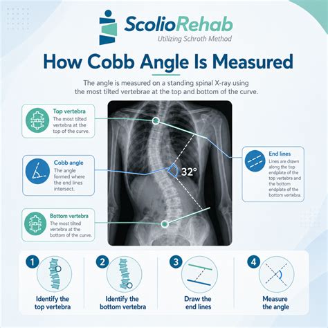 Cobb Angle In Scoliosis What It Means And Why It Matters