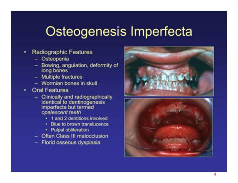 Osteogenesis Imperfecta Teeth