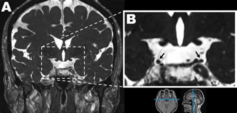 A Coronal T2 Weighted Ciss Mri 3 T And B A Magnified Section Showing