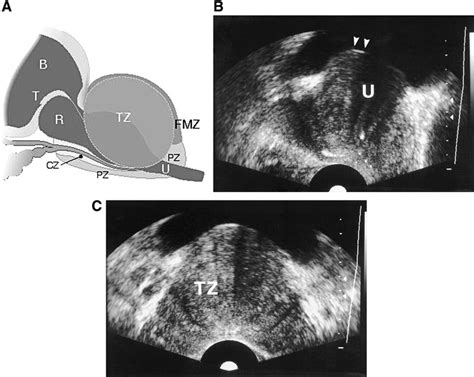 Ultrasound Type 3 Bph Bilateral And Retrourethral A Diagrammatic