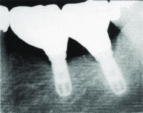Radiographic Evidence Of Early Implant Bone Loss The Crestal Bone Loss Download Scientific
