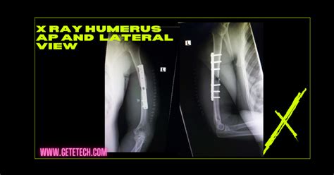 Shoulder X Ray Positions